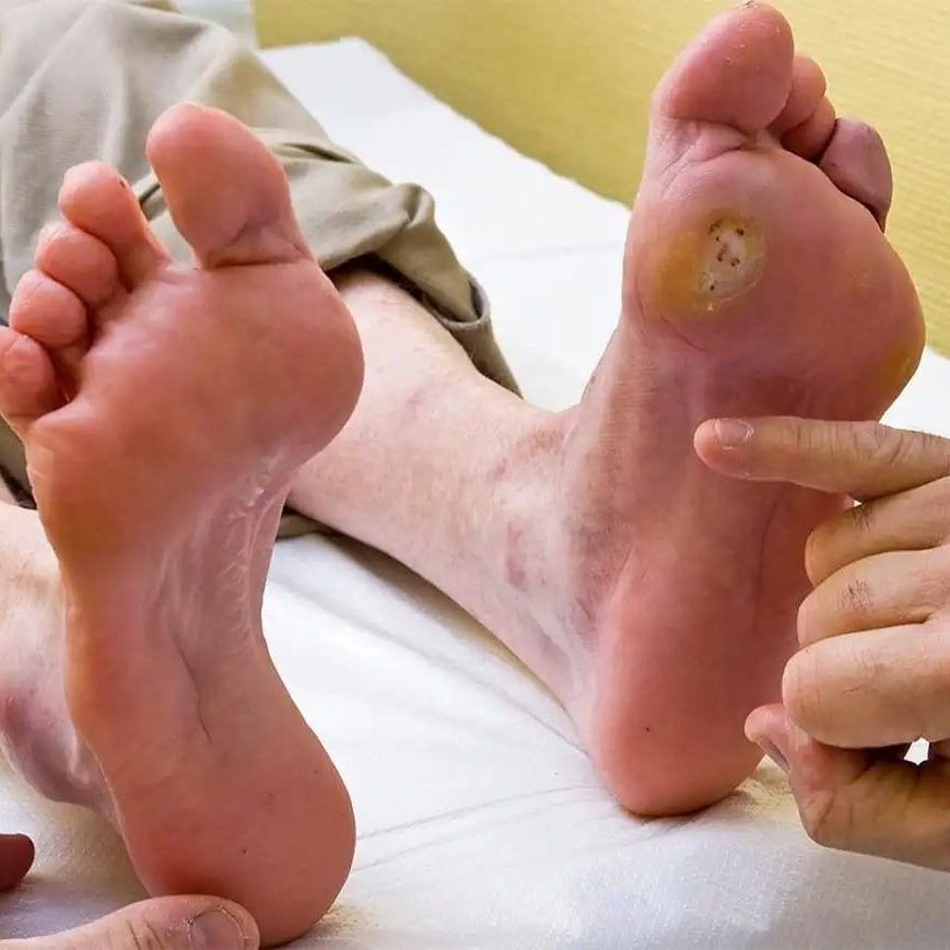 Ulcera No Pe Diabetico Em Estagio Inicial
